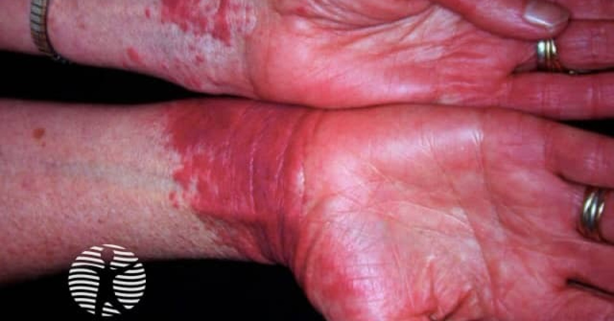 Contact allergic dermatitis of the hands image