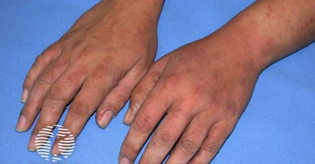 DermNet® - Contact allergic dermatitis of the hands image