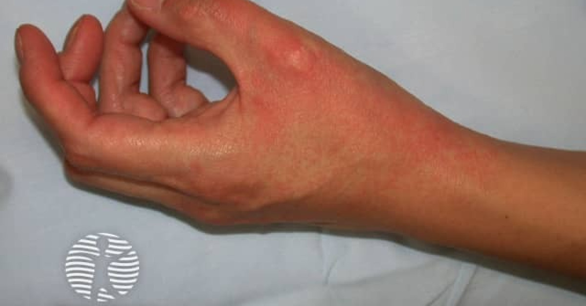 Contact allergic dermatitis of the hands image