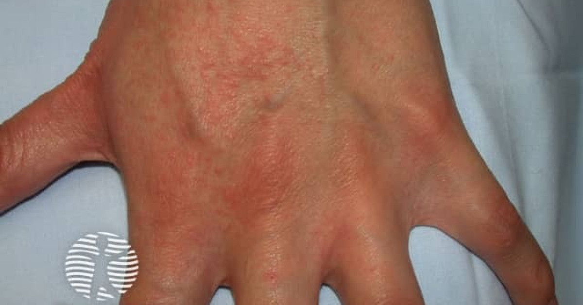 Contact allergic dermatitis of the hands image