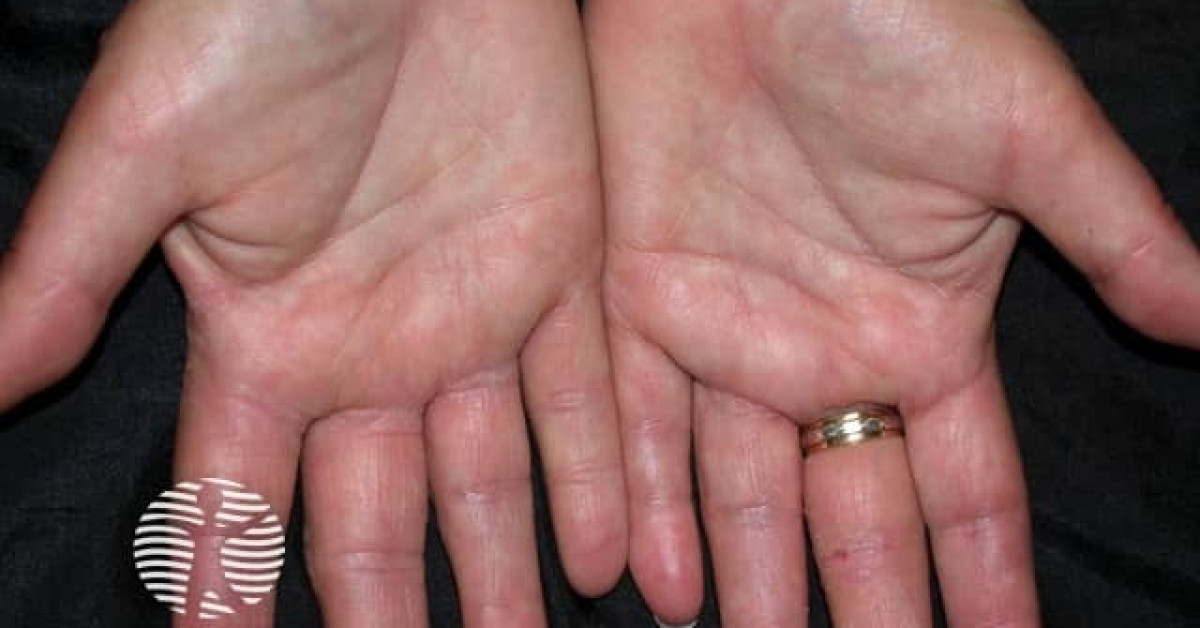 Contact allergic dermatitis of the hands image