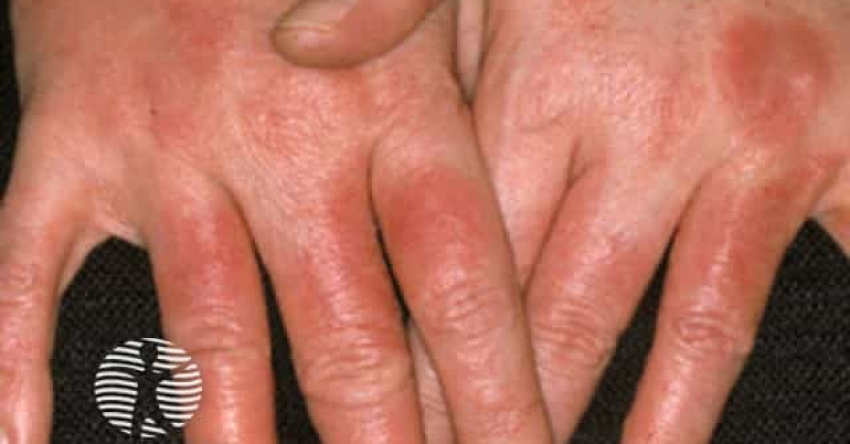 Contact allergic dermatitis of the hands image