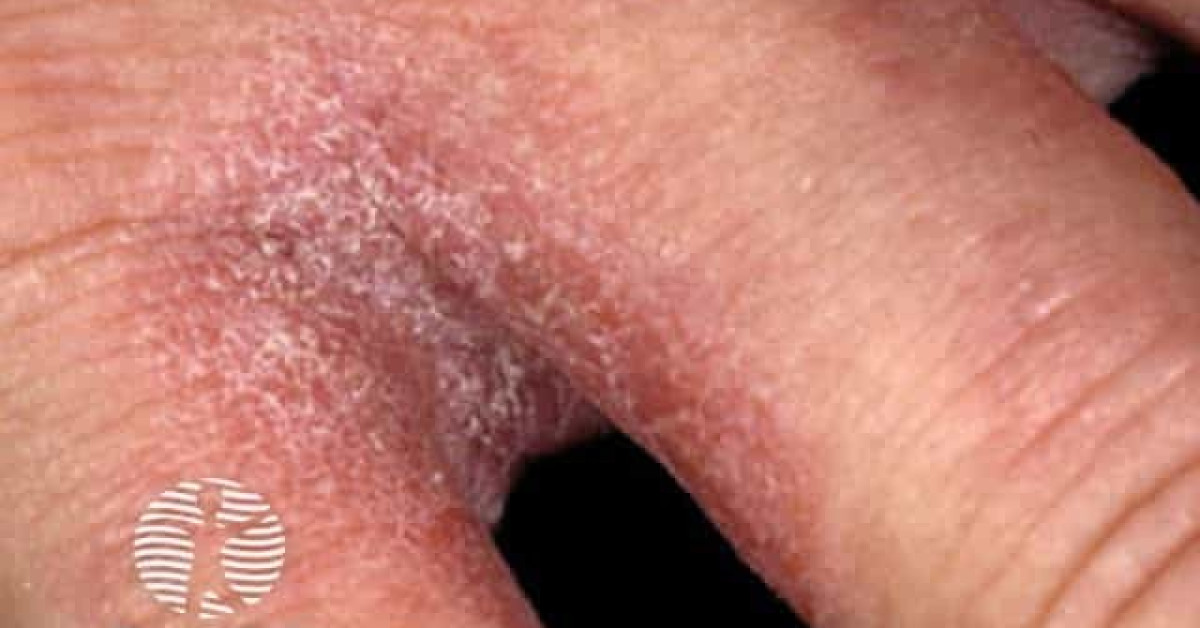 Contact allergic dermatitis of the hands image