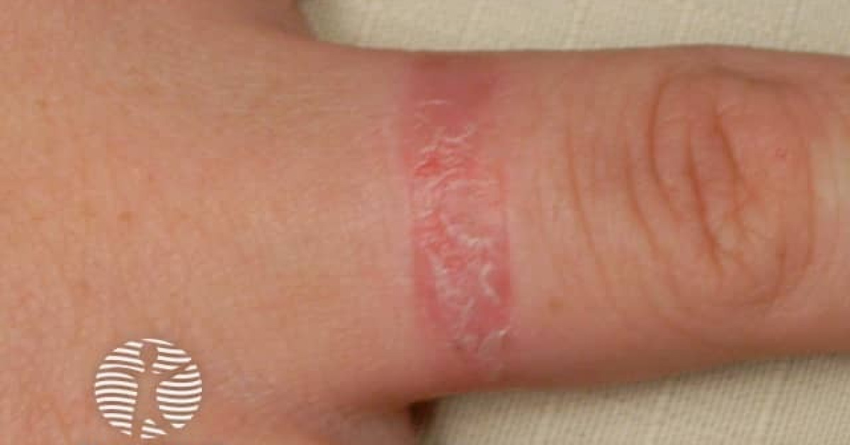 Contact allergic dermatitis of the hands image