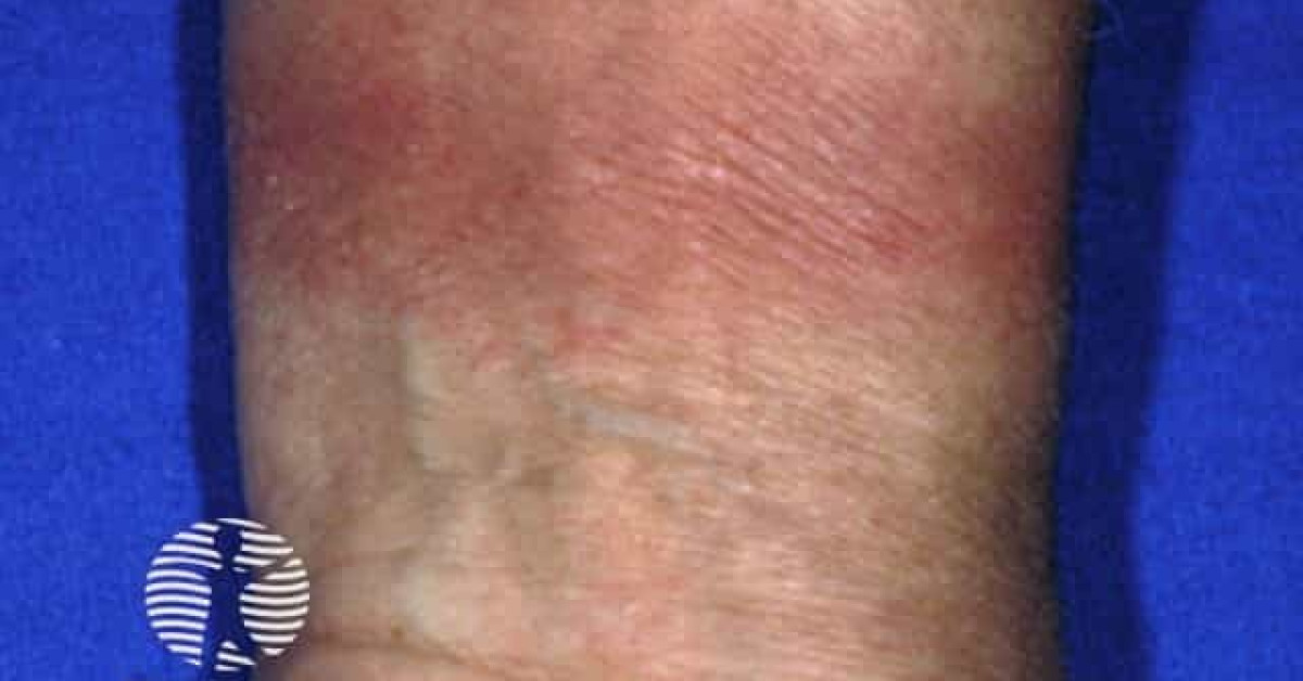 Contact allergic dermatitis of the arms and legs image