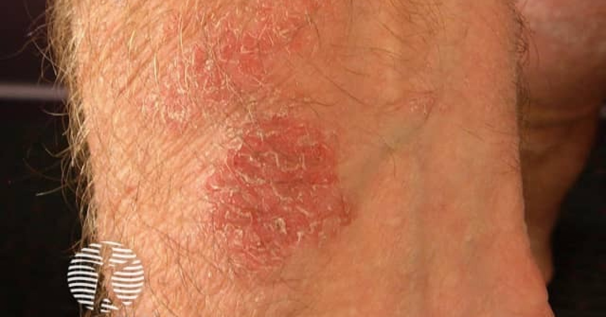 Contact allergic dermatitis of the arms and legs image