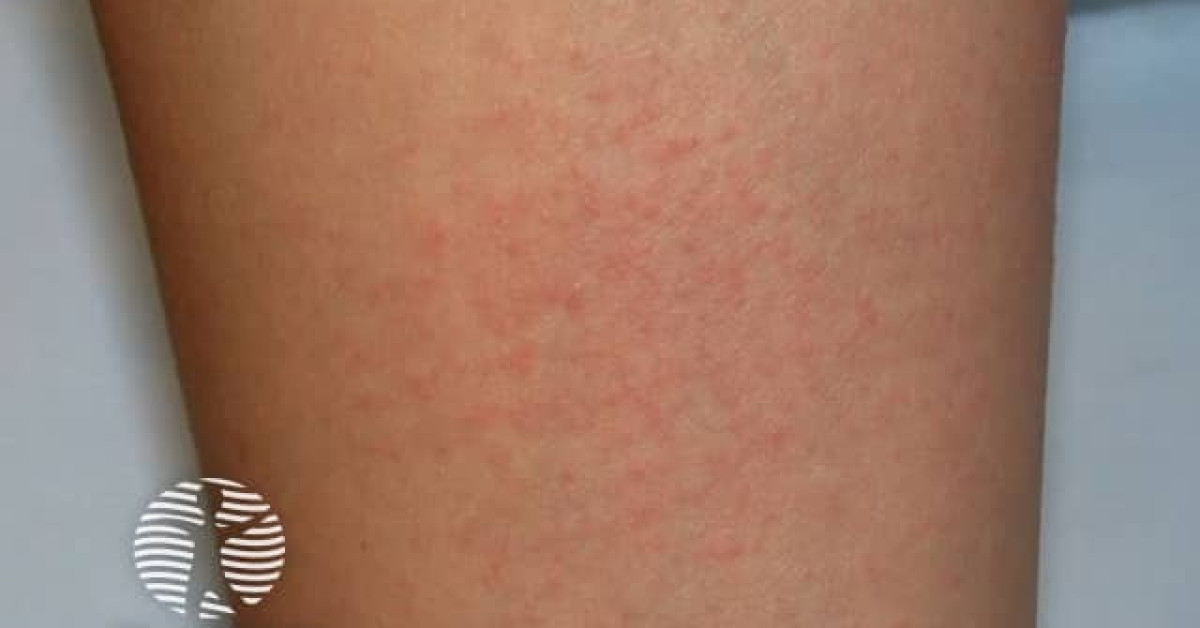 Contact allergic dermatitis of the arms and legs image