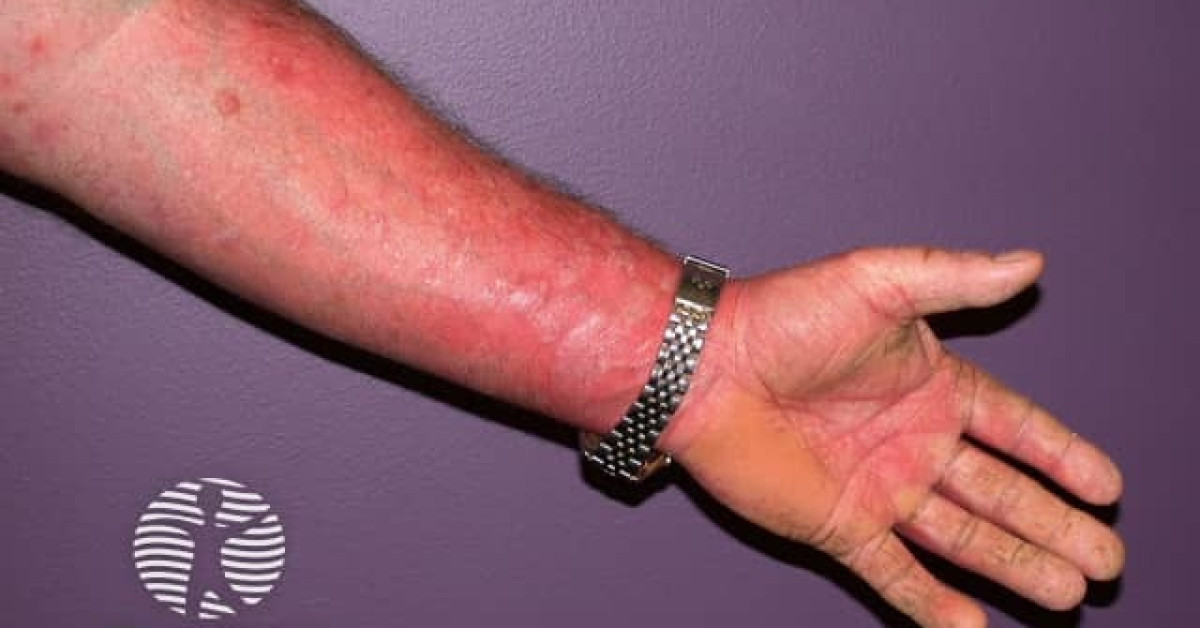 Contact allergic dermatitis of the arms and legs image