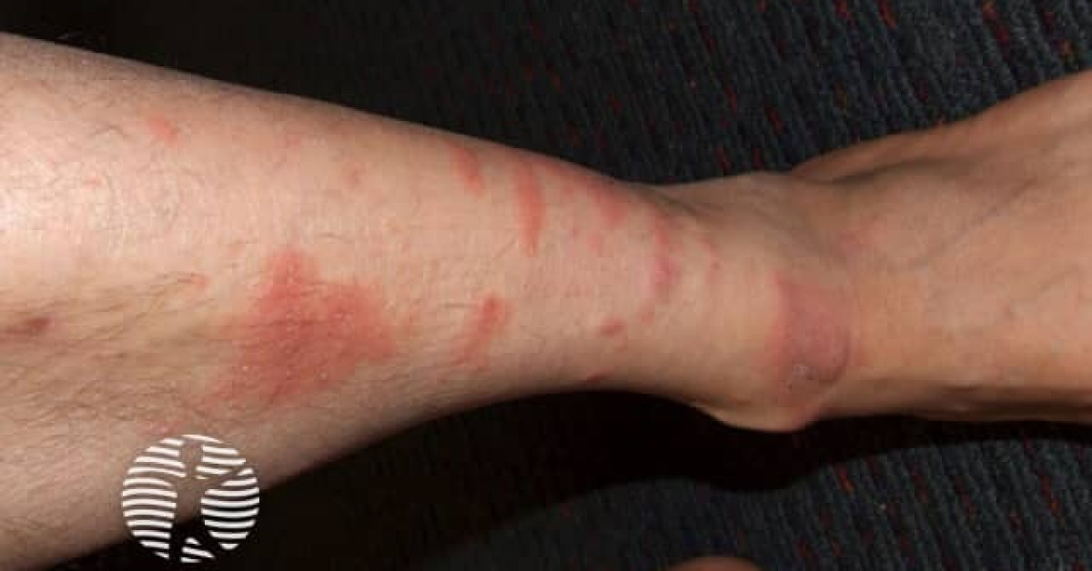 Contact allergic dermatitis of the arms and legs image