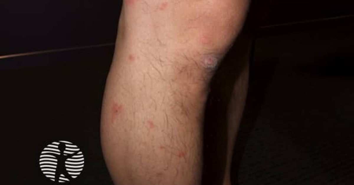 Contact allergic dermatitis of the arms and legs image