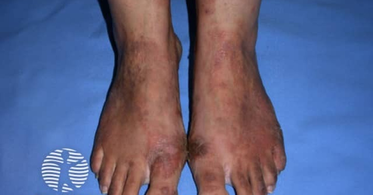 Contact allergic dermatitis of the arms and legs image