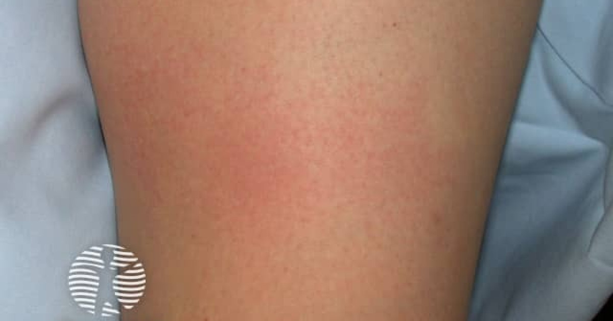 Contact allergic dermatitis of the arms and legs image