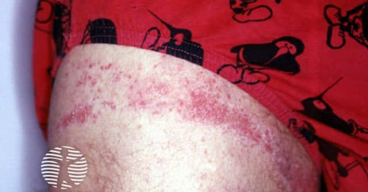 Rubber dermatitis image