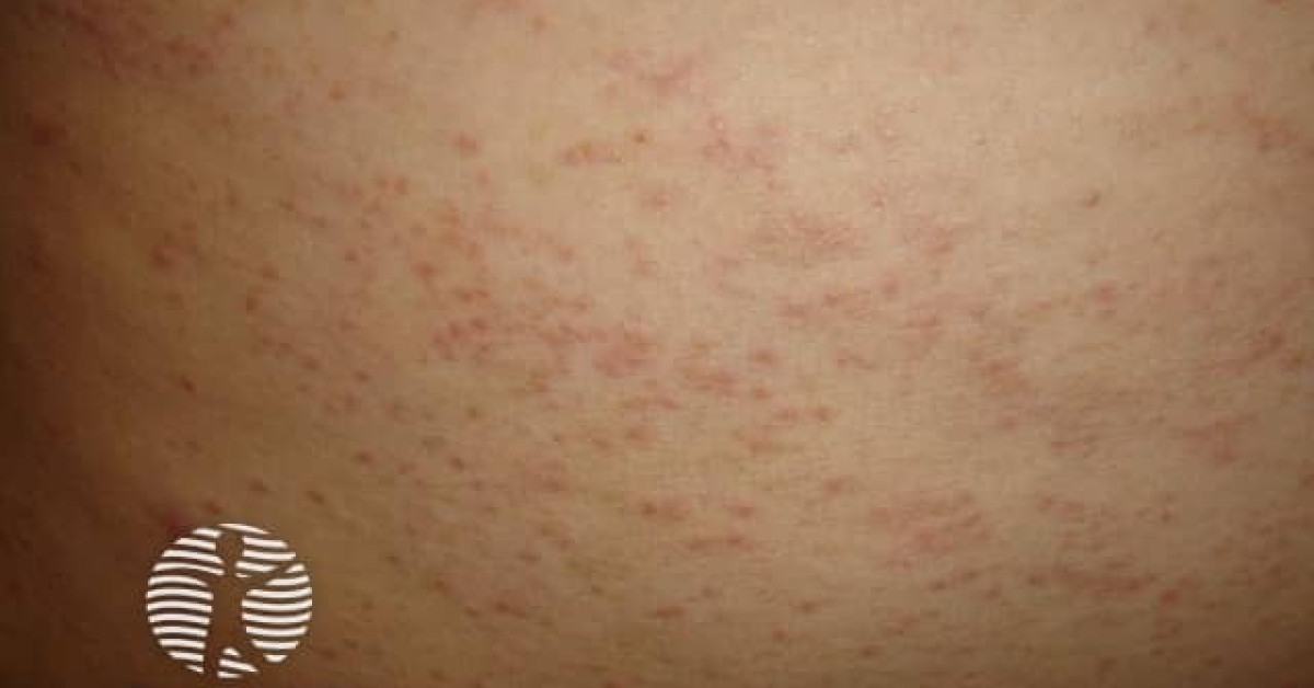Contact allergic dermatitis of the torso image