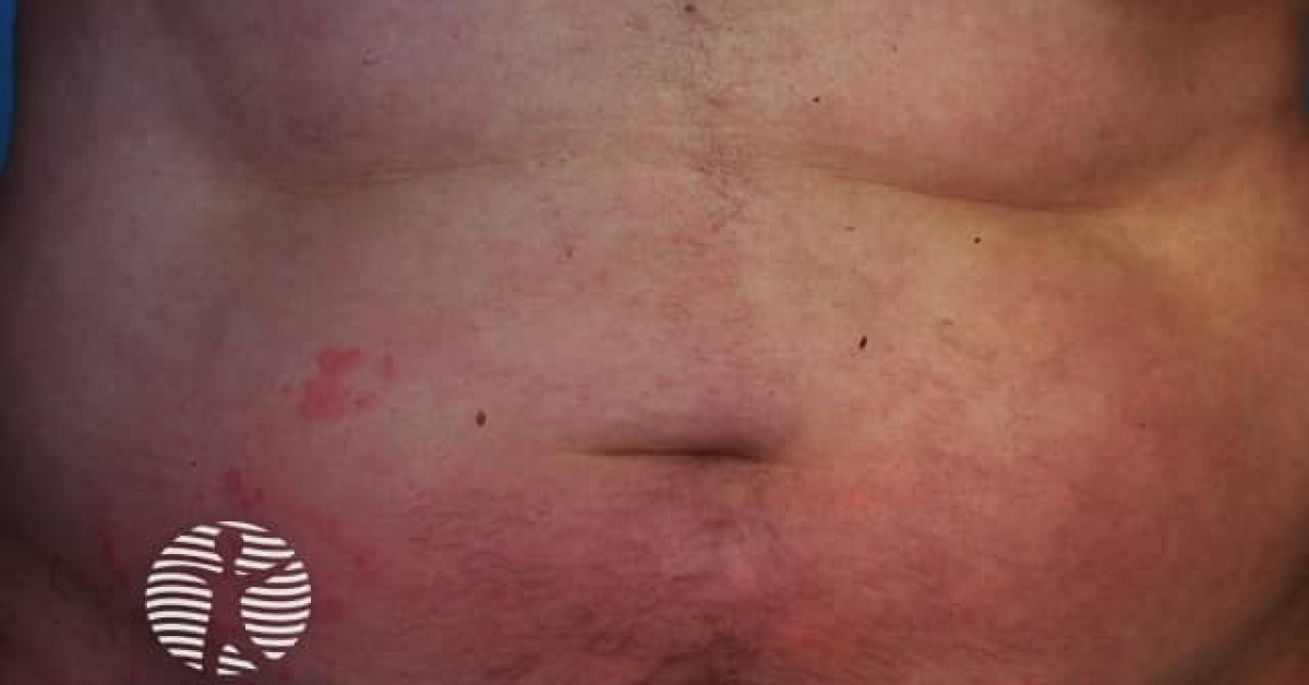 Contact allergic dermatitis of the torso image