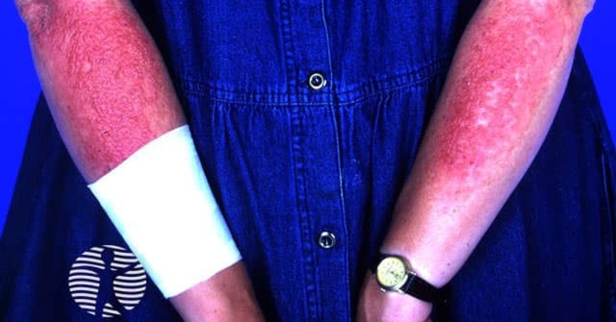 Photocontact dermatitis image