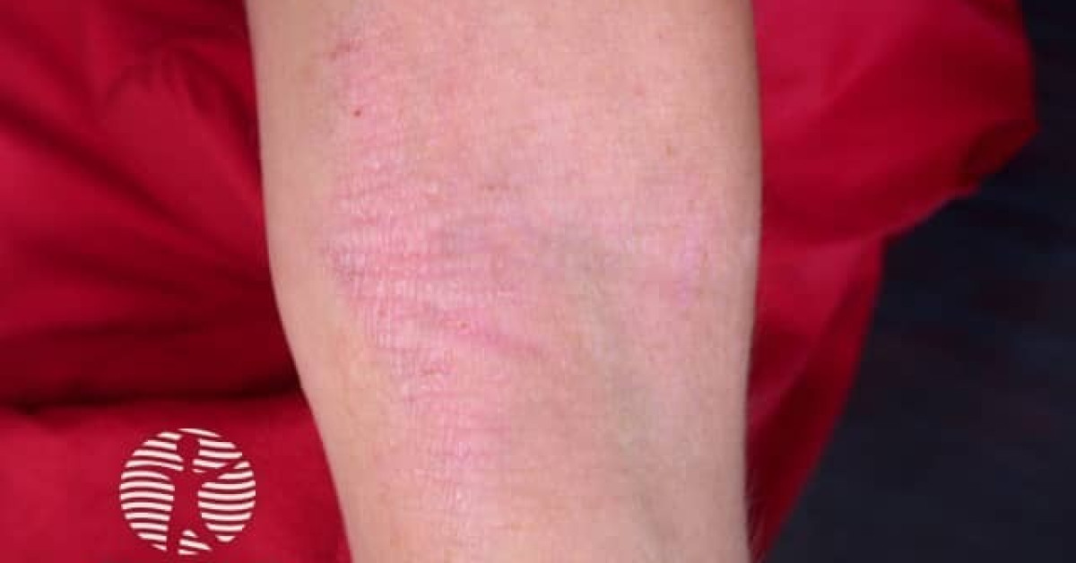 Atopic eczema image