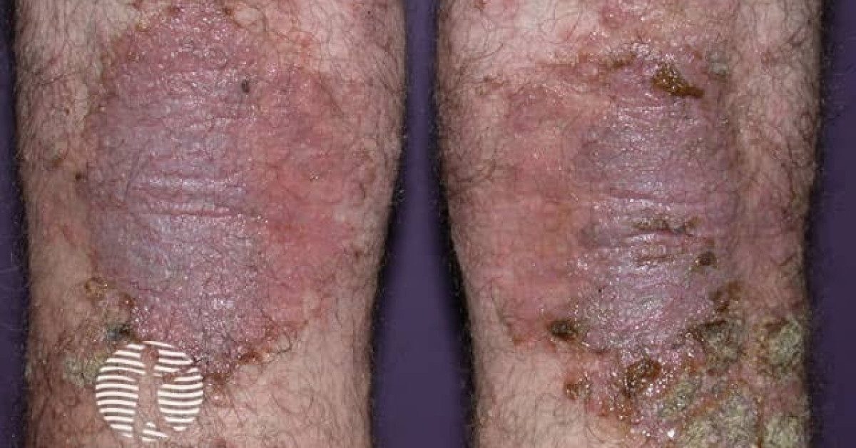 Infected dermatitis image