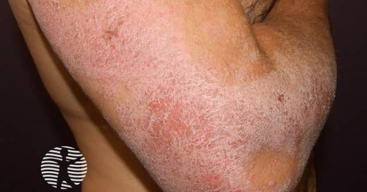 DermNet® - Atopic dermatitis image