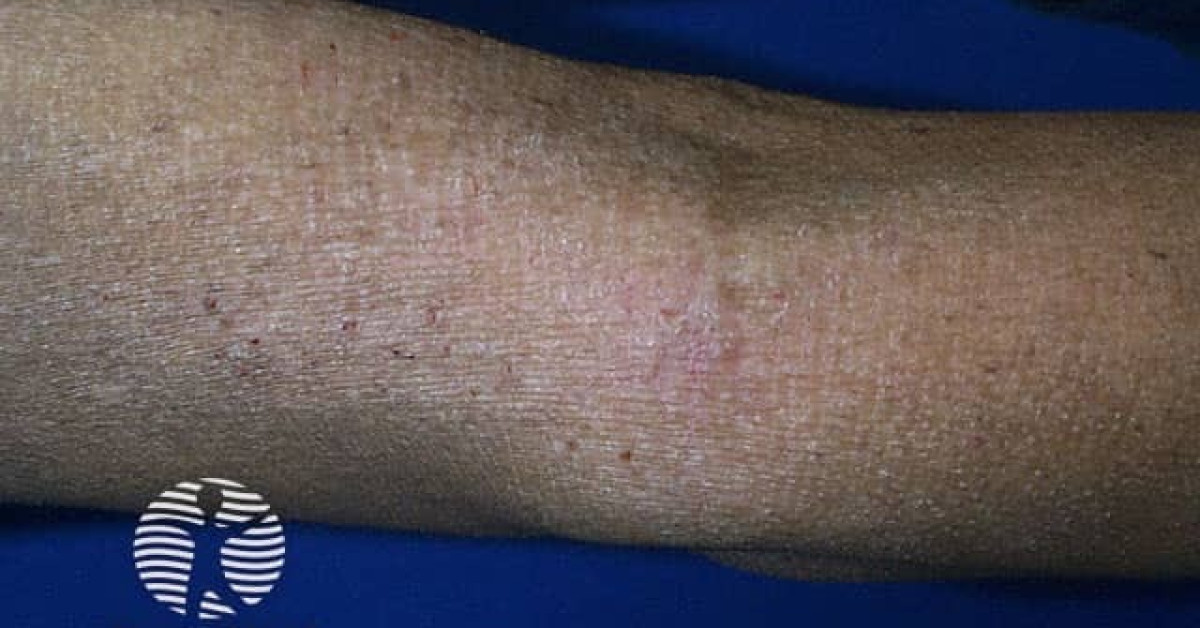 Atopic dermatitis image