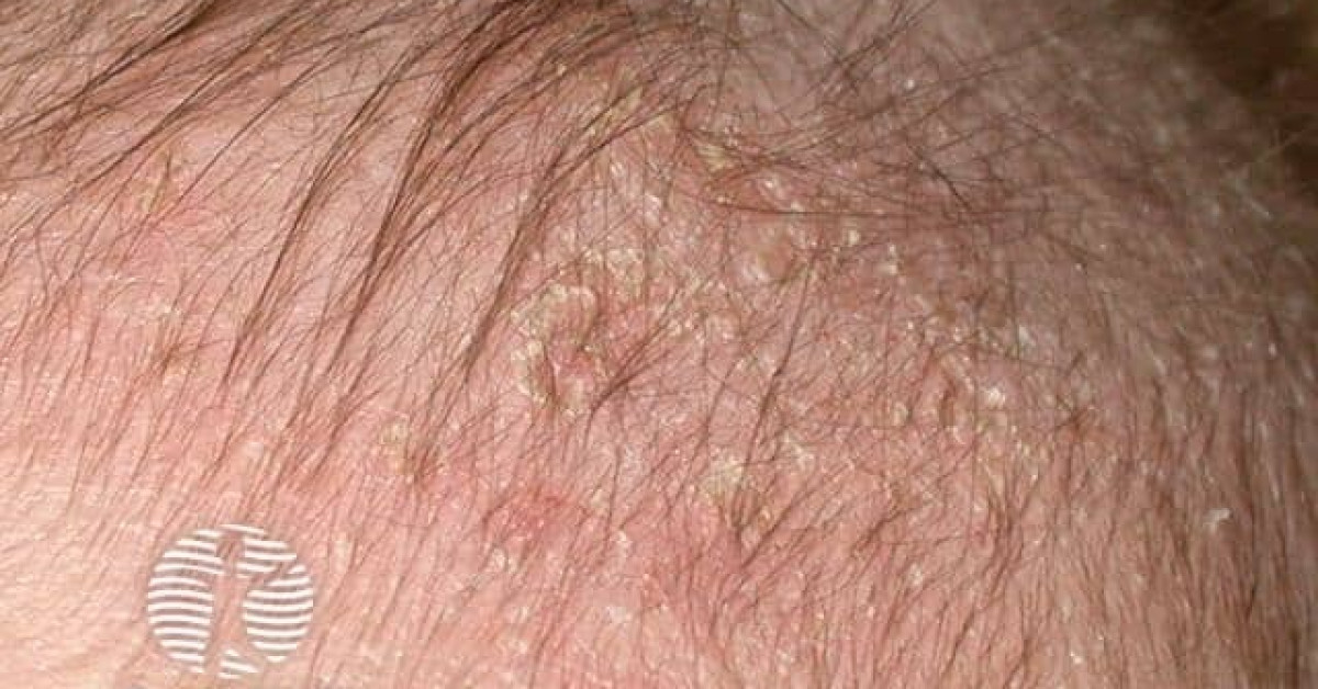 Cradle cap image