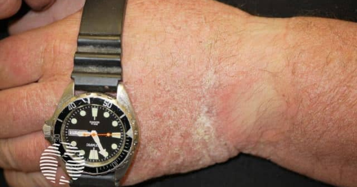 Contact dermatitis due to neoprene and diethylthiourea allergy image