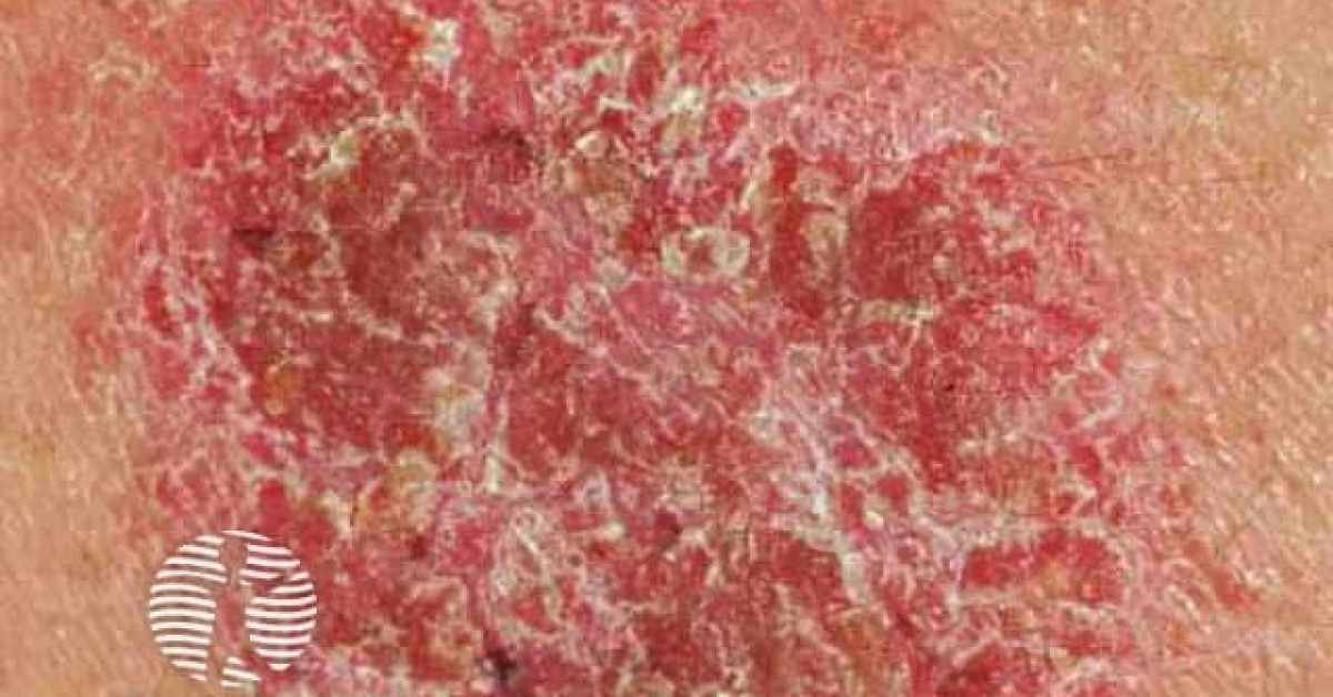 Discoid Eczema Image