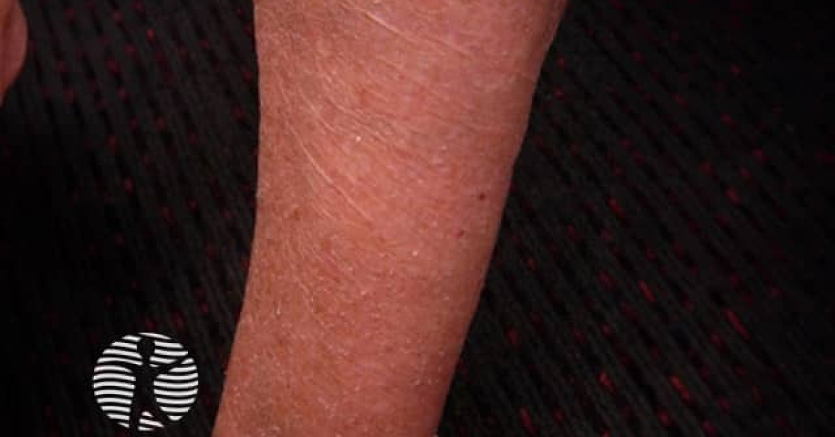 Dry skin image