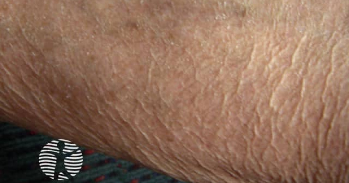 Dry skin image