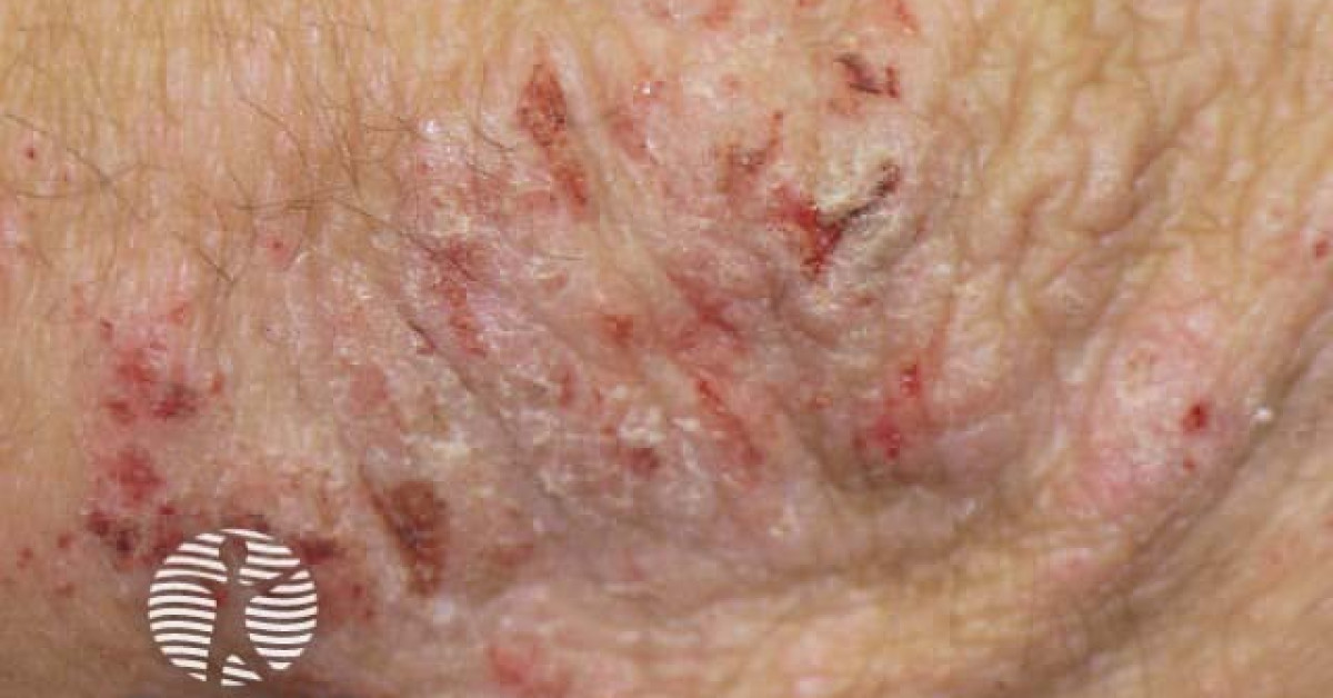 DermNet® - Eczema image