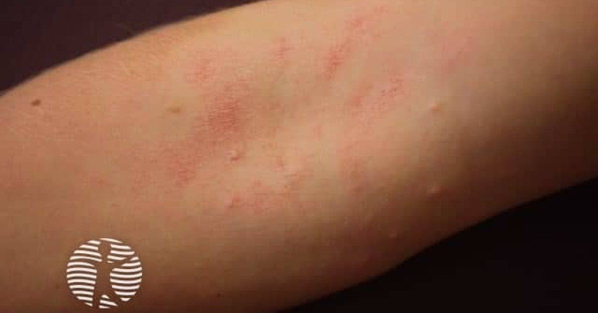 Atopic dermatitis image