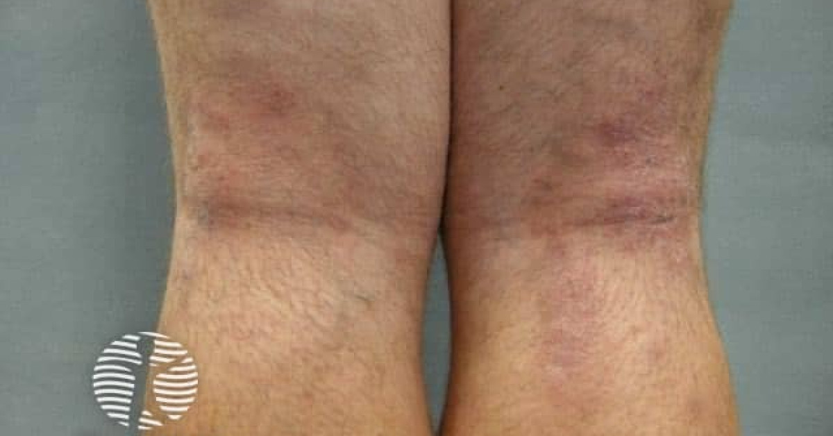 Atopic dermatitis image