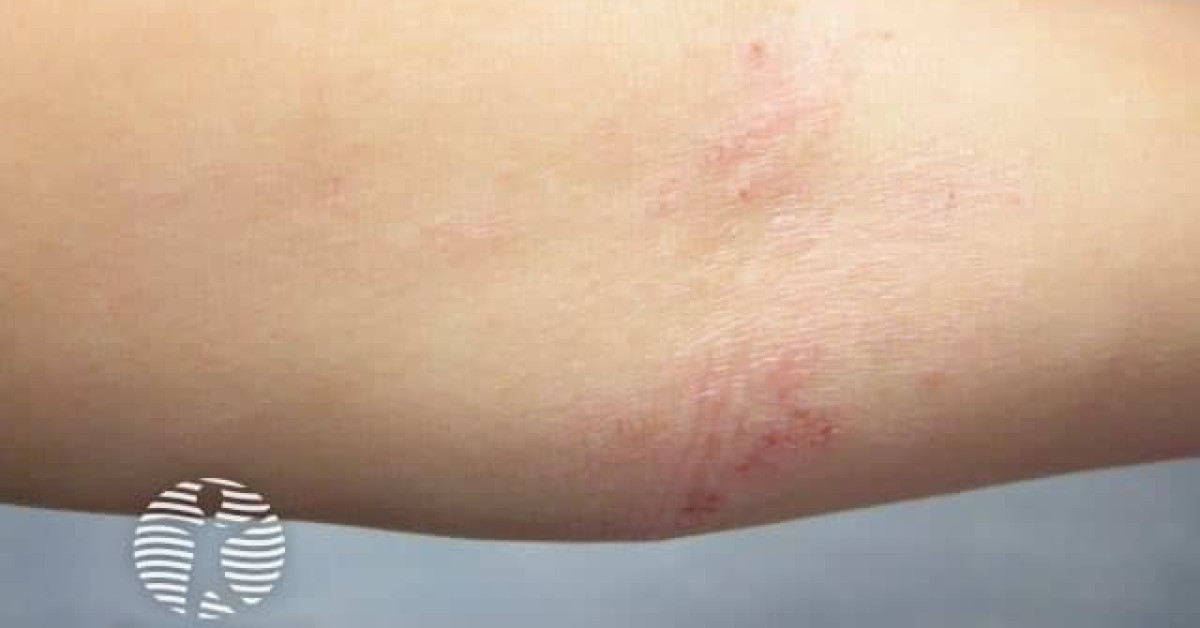 Atopic dermatitis image