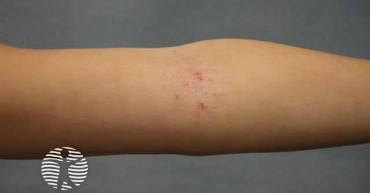 Atopic dermatitis image