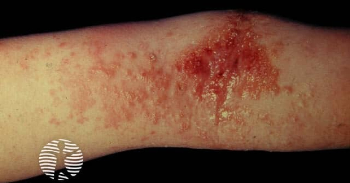 Atopic dermatitis image