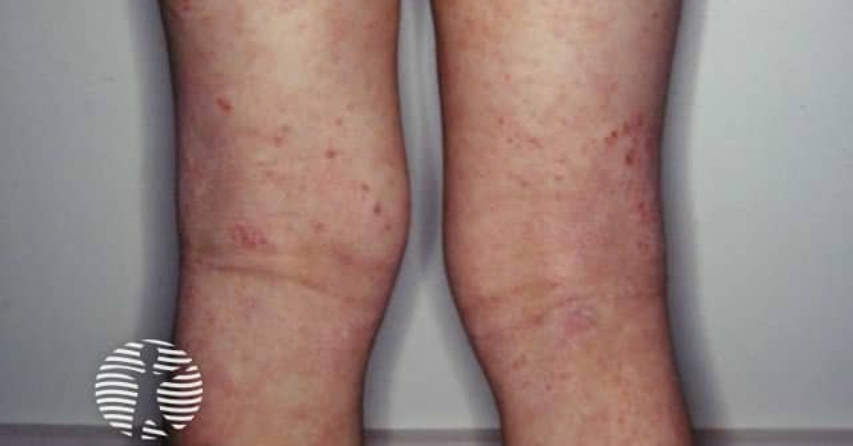 Atopic dermatitis image