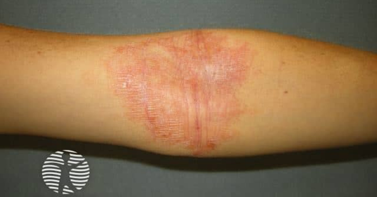 Atopic dermatitis image