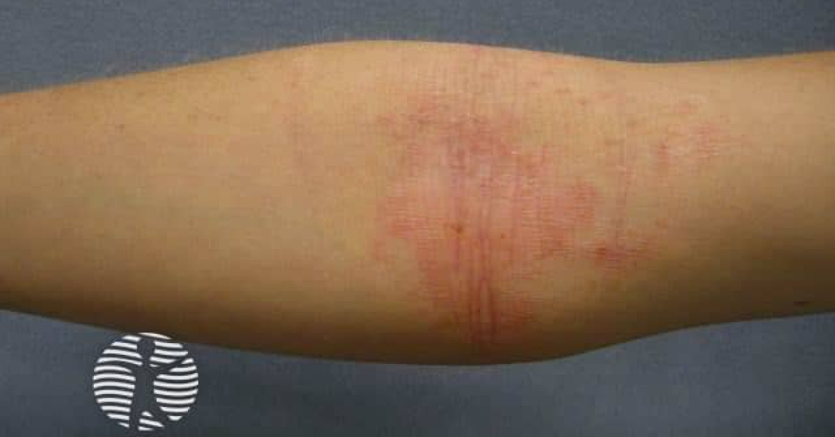 Atopic dermatitis image