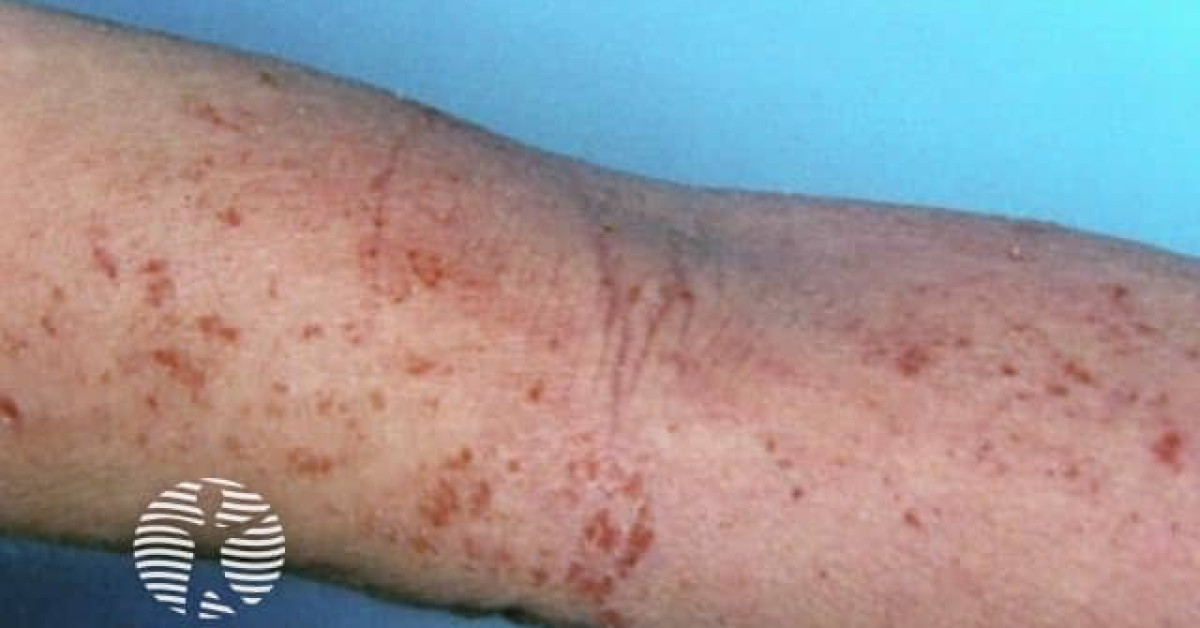 Atopic dermatitis image