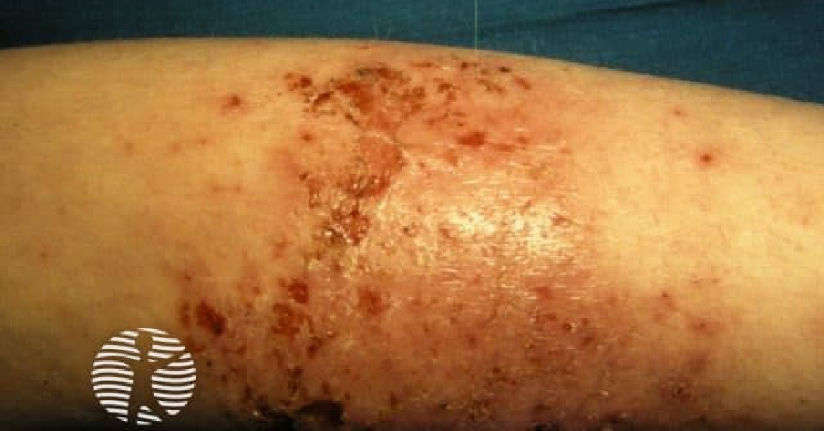 Atopic dermatitis image
