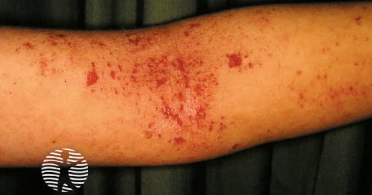 Atopic dermatitis image
