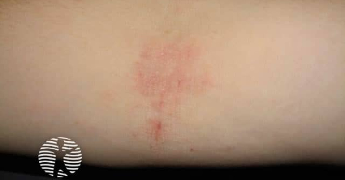Atopic dermatitis image