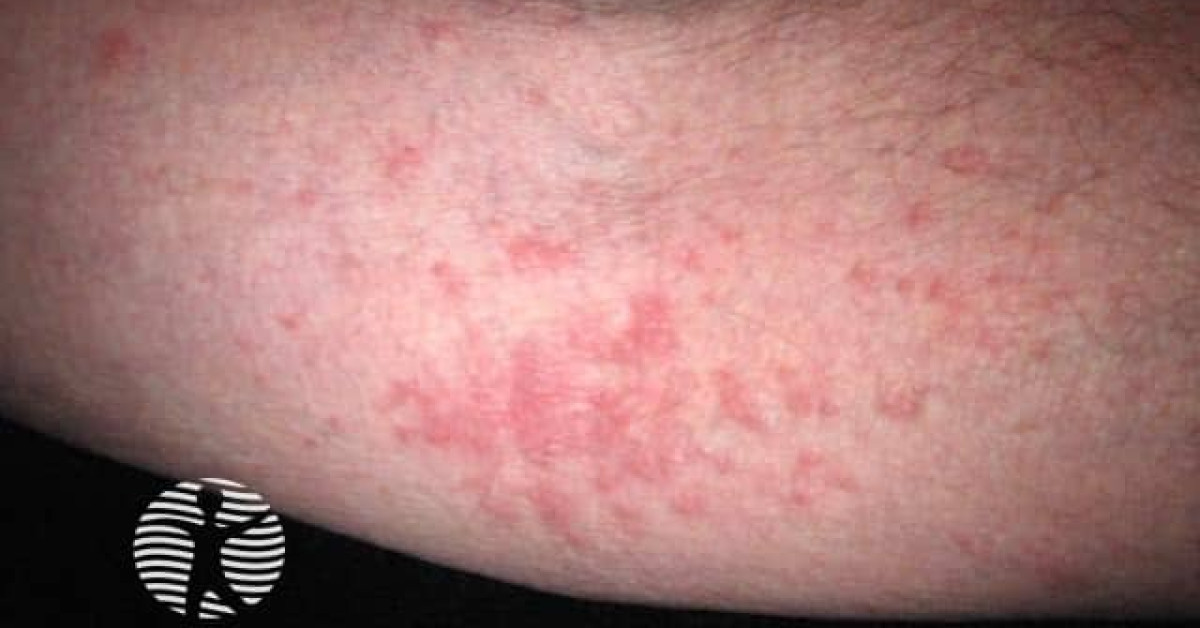 Atopic dermatitis image