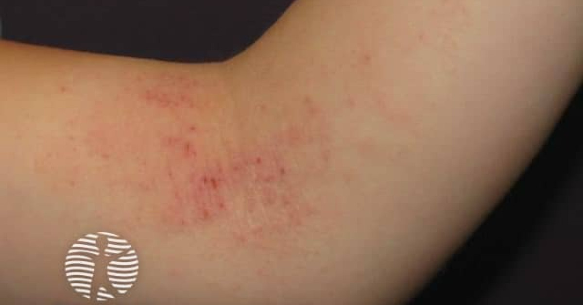 Atopic dermatitis image