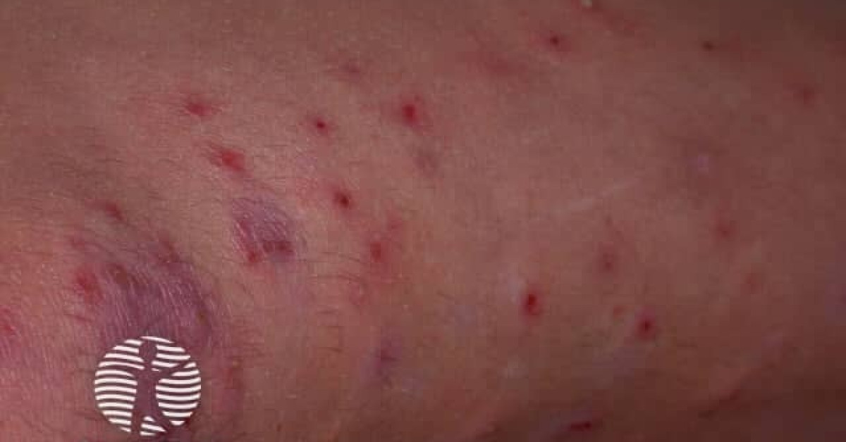 Infected dermatitis image
