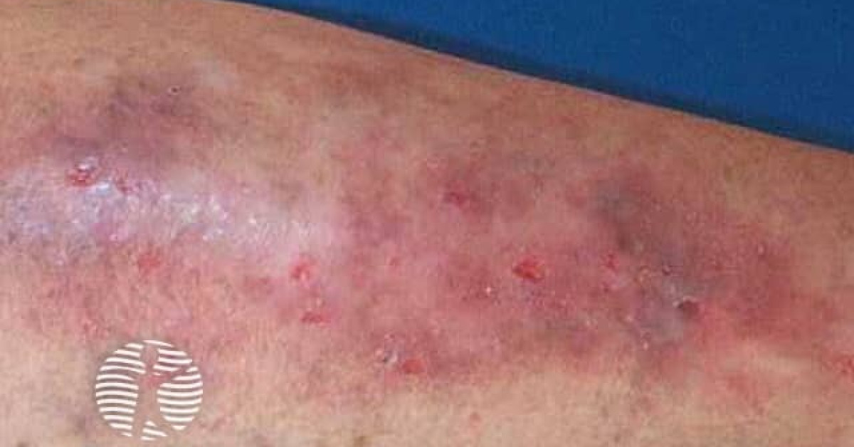 Venous eczema image