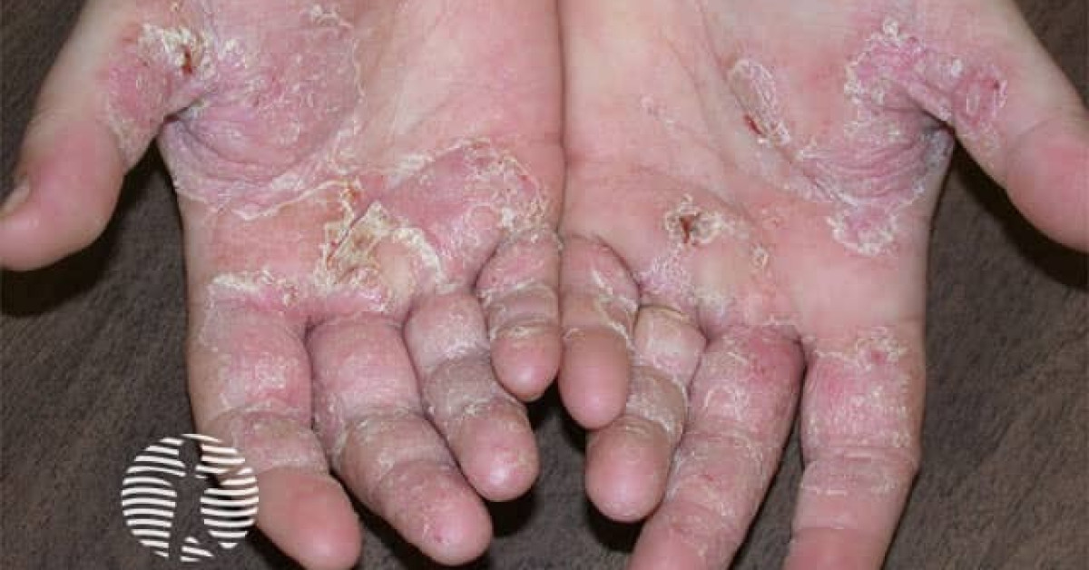 Hand dermatitis image