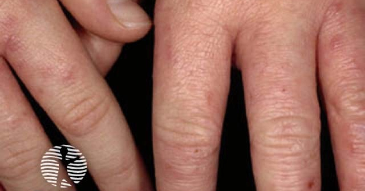 Hand dermatitis image