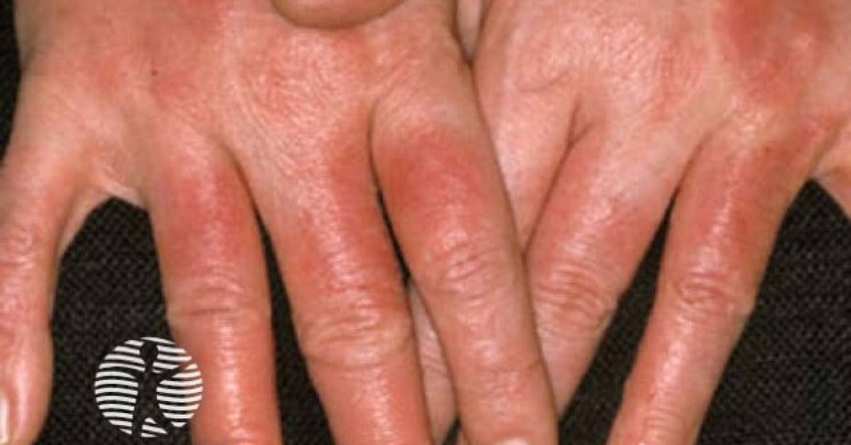 Hand dermatitis image