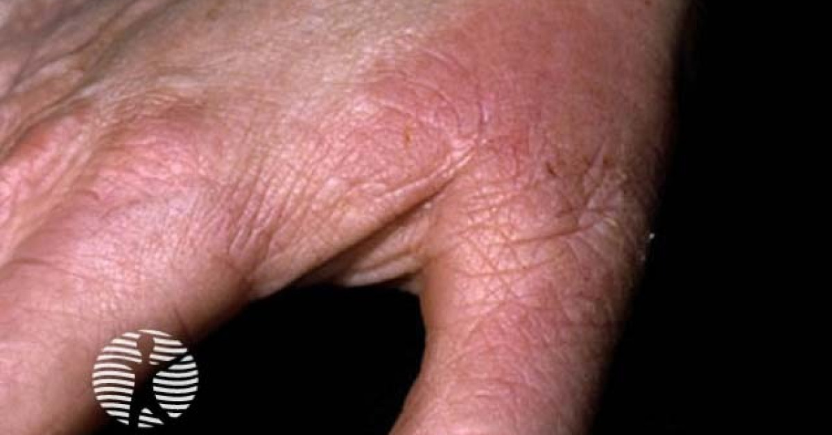 Hand dermatitis image
